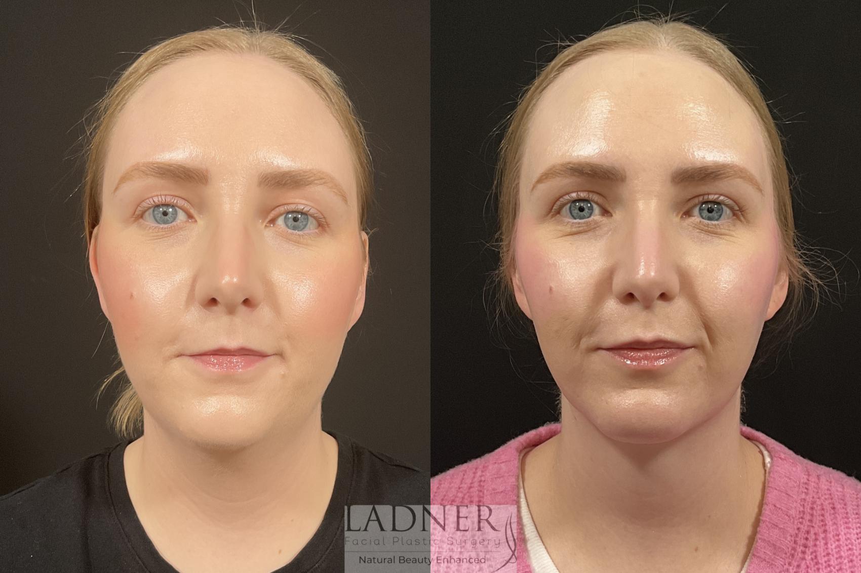 Chin Augmentation Before and After Pictures Case 313 | Denver, CO ...