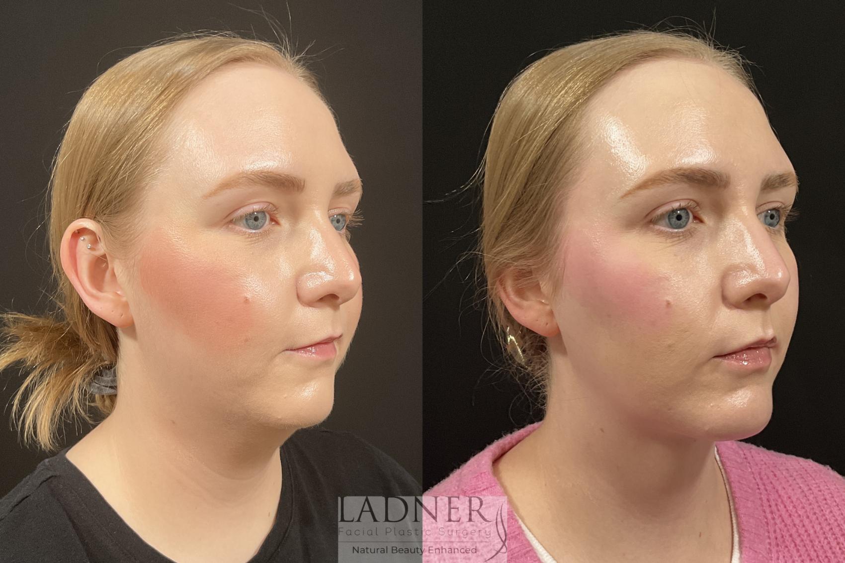 Chin Augmentation Before and After Pictures Case 313 | Denver, CO ...