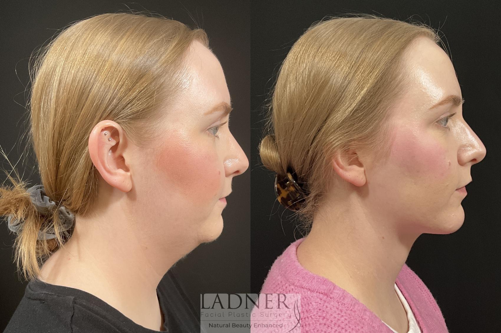 Chin Augmentation Before and After Pictures Case 313 | Denver, CO ...