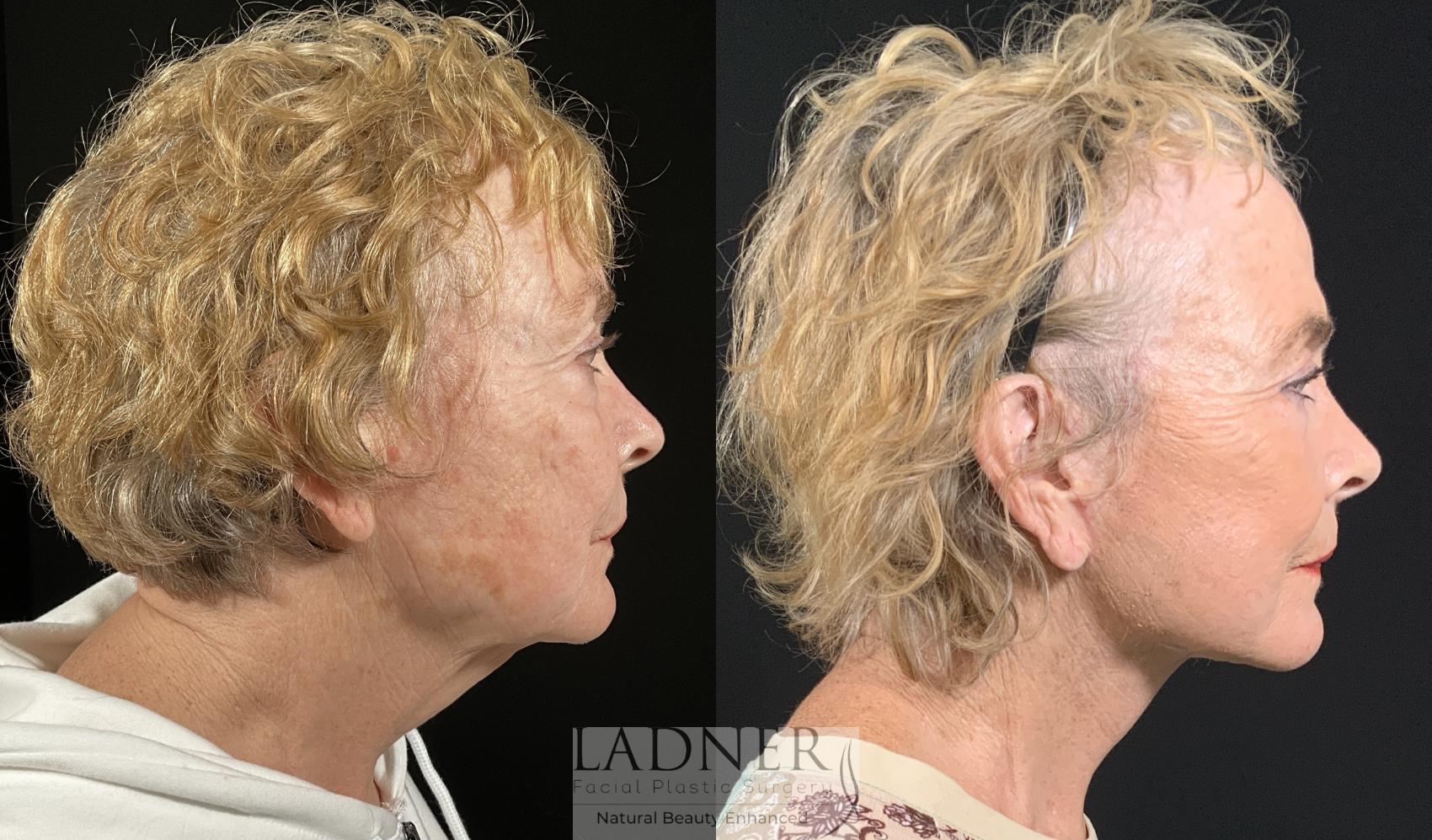 Deep Plane Facelift / Neck Lift Before and After Pictures Case 248 | Denver, CO | Ladner Facial ...