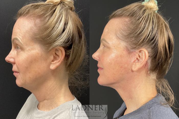 Chin Augmentation Before and After Pictures Case 250 | Denver, CO ...