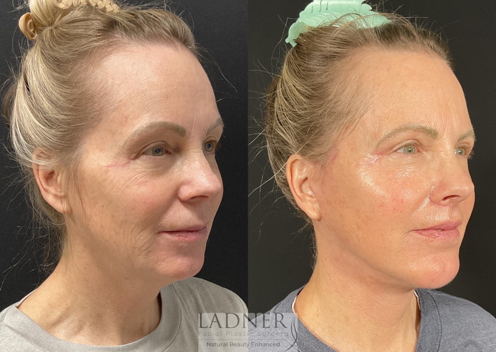 Deep Plane Facelift / Neck Lift Before and After Pictures Case 250 ...