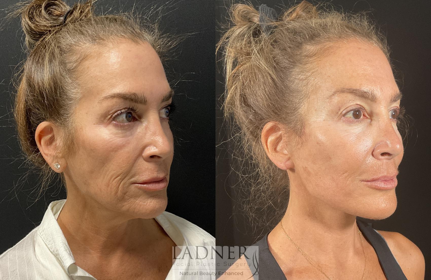 Deep Plane Facelift / Neck Lift Before and After Pictures Case 254 ...