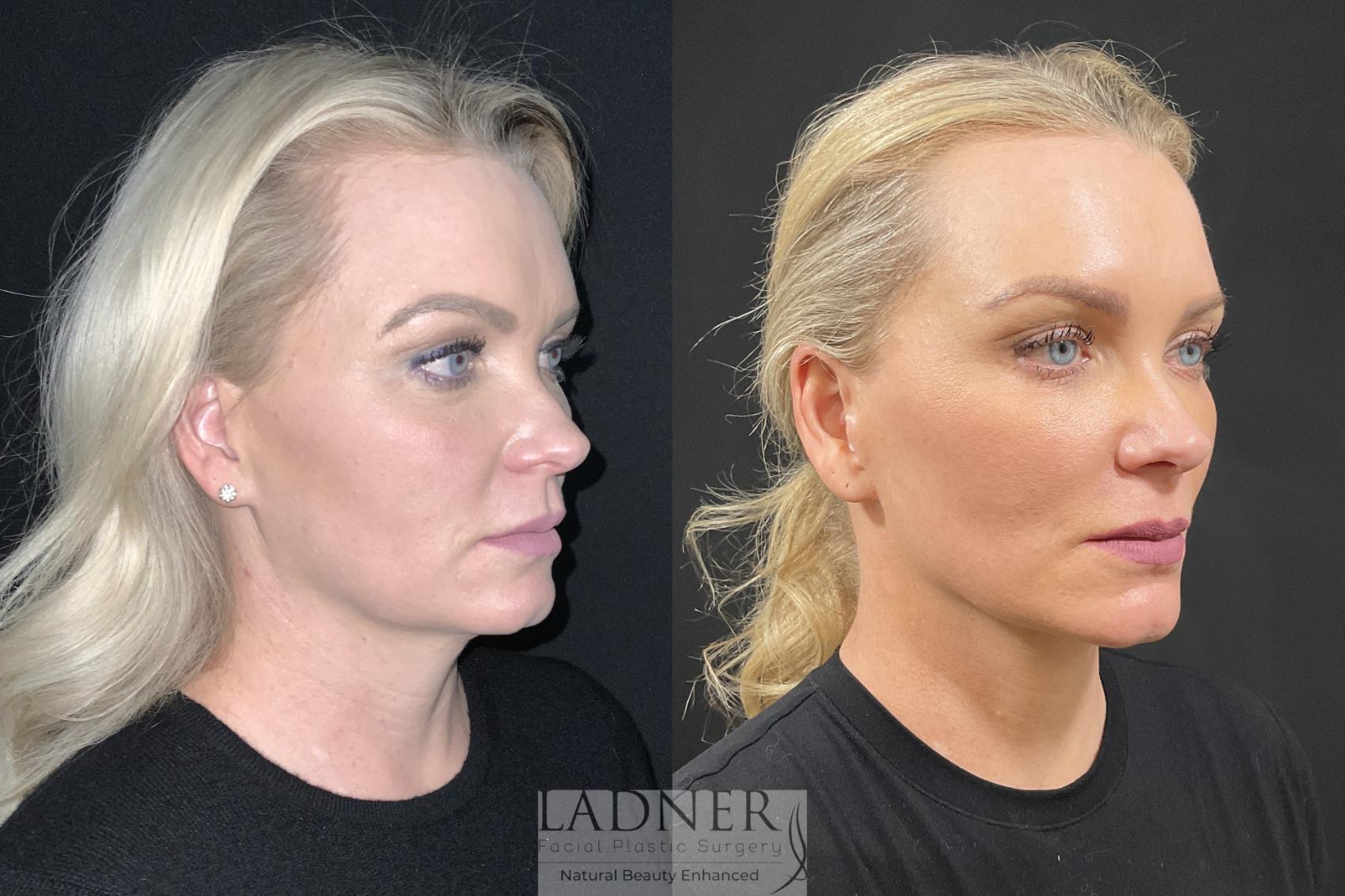 Deep Plane Facelift / Neck Lift Before and After Pictures Case 305 | Denver, CO | Ladner Facial ...