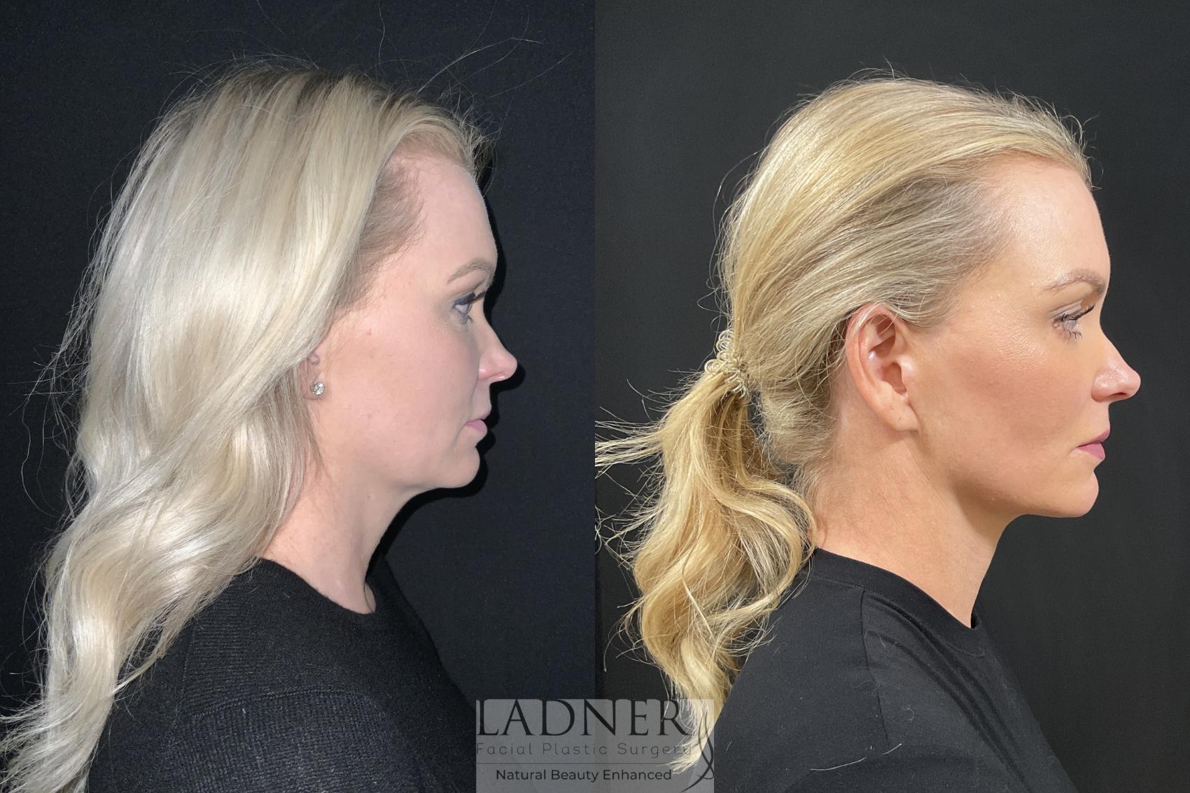Deep Plane Facelift / Neck Lift Before and After Pictures Case 305 | Denver, CO | Ladner Facial ...
