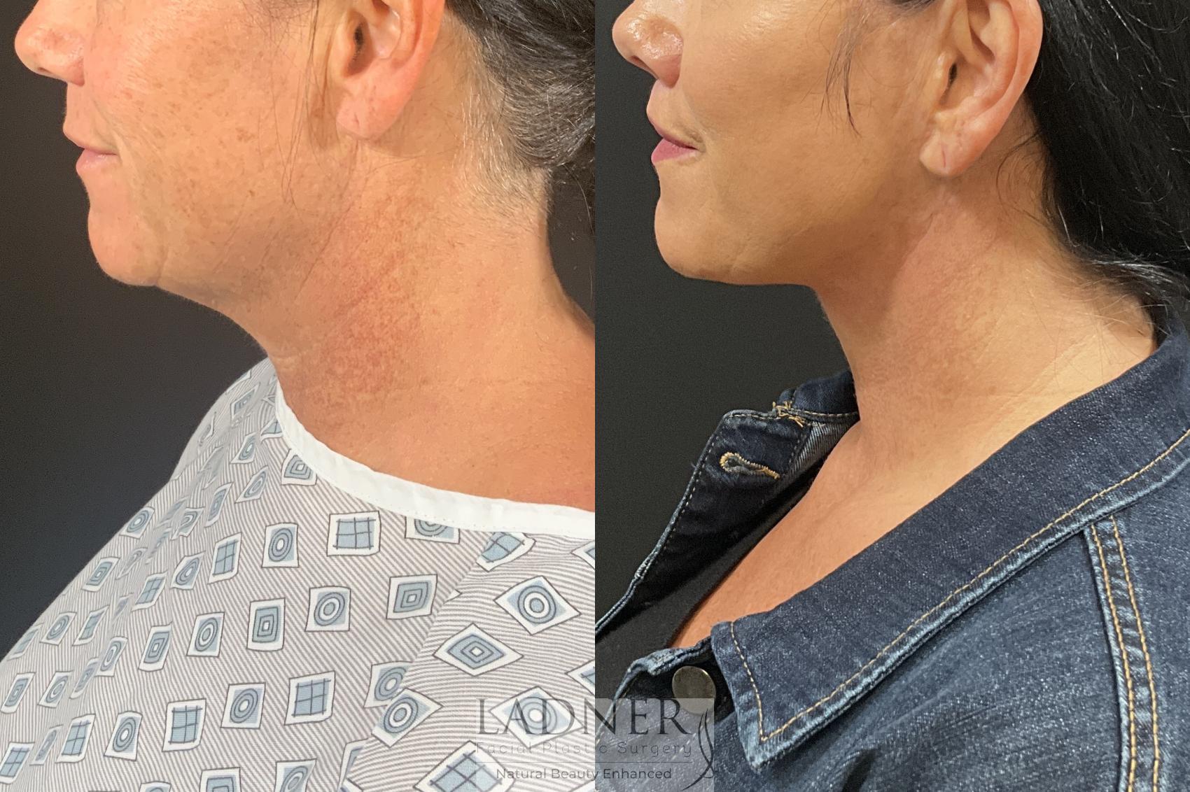 Deep Plane Facelift / Neck Lift Before and After Pictures Case 308 ...