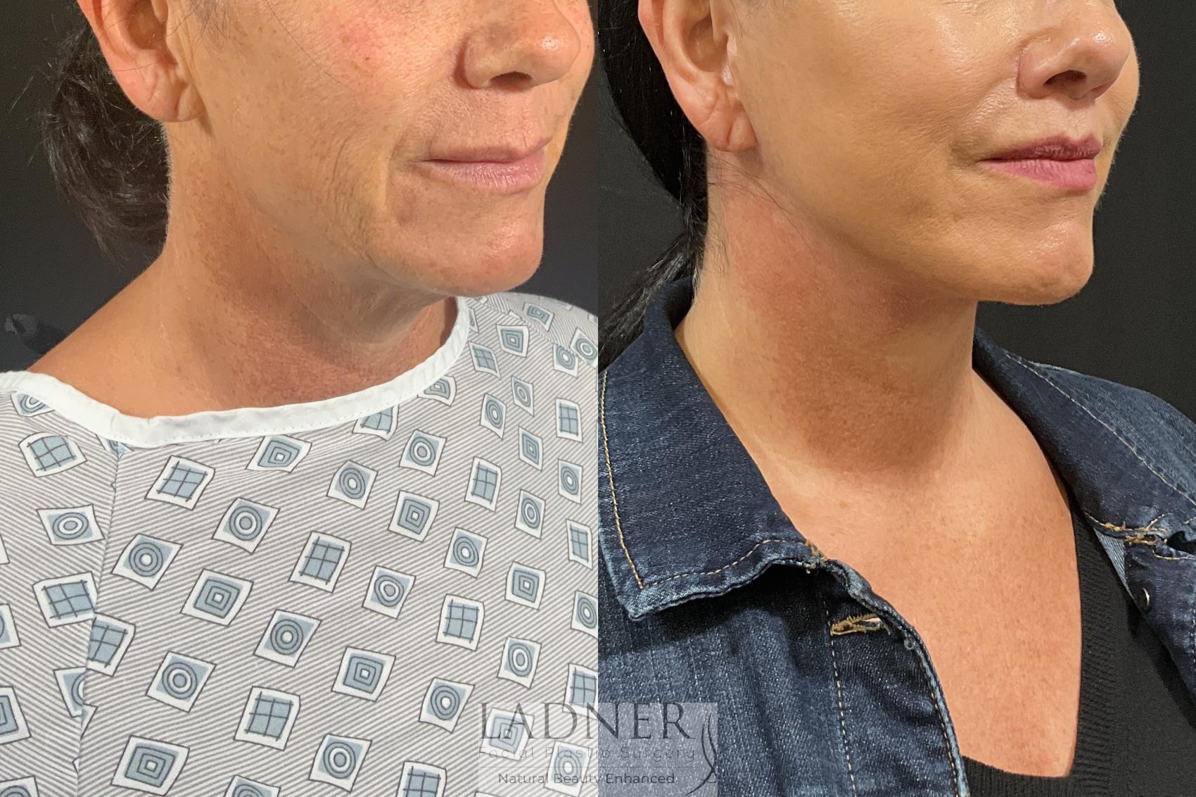 Deep Plane Facelift / Neck Lift Before and After Pictures Case 308 | Denver, CO | Ladner Facial ...