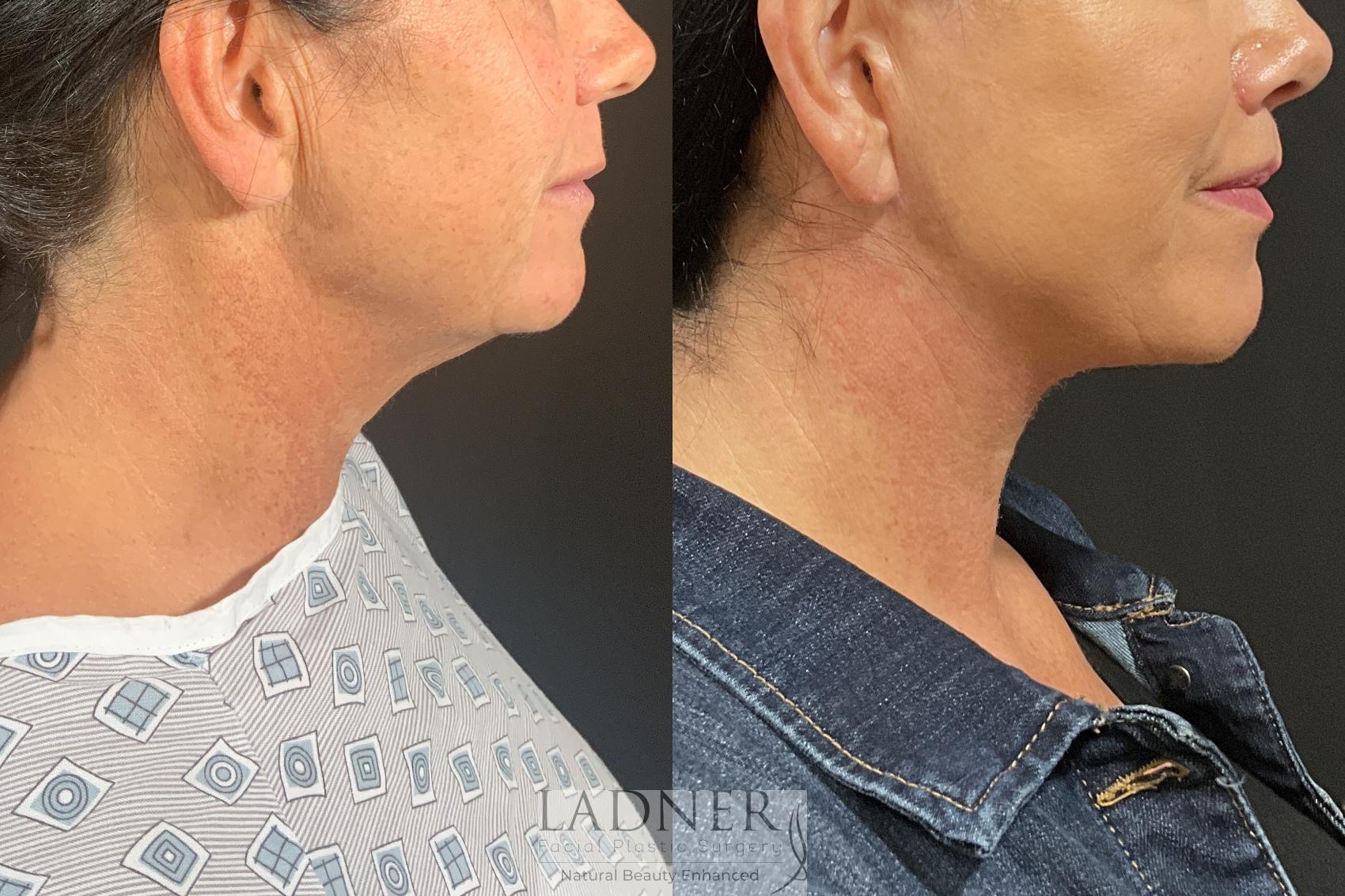 Deep Plane Facelift / Neck Lift Before and After Pictures Case 308 ...