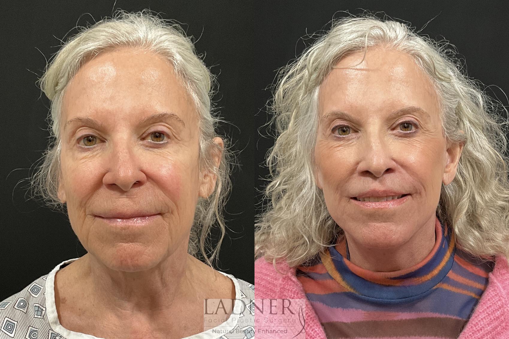 Deep Plane Facelift / Neck Lift Before and After Pictures Case 314 | Denver, CO | Ladner Facial ...
