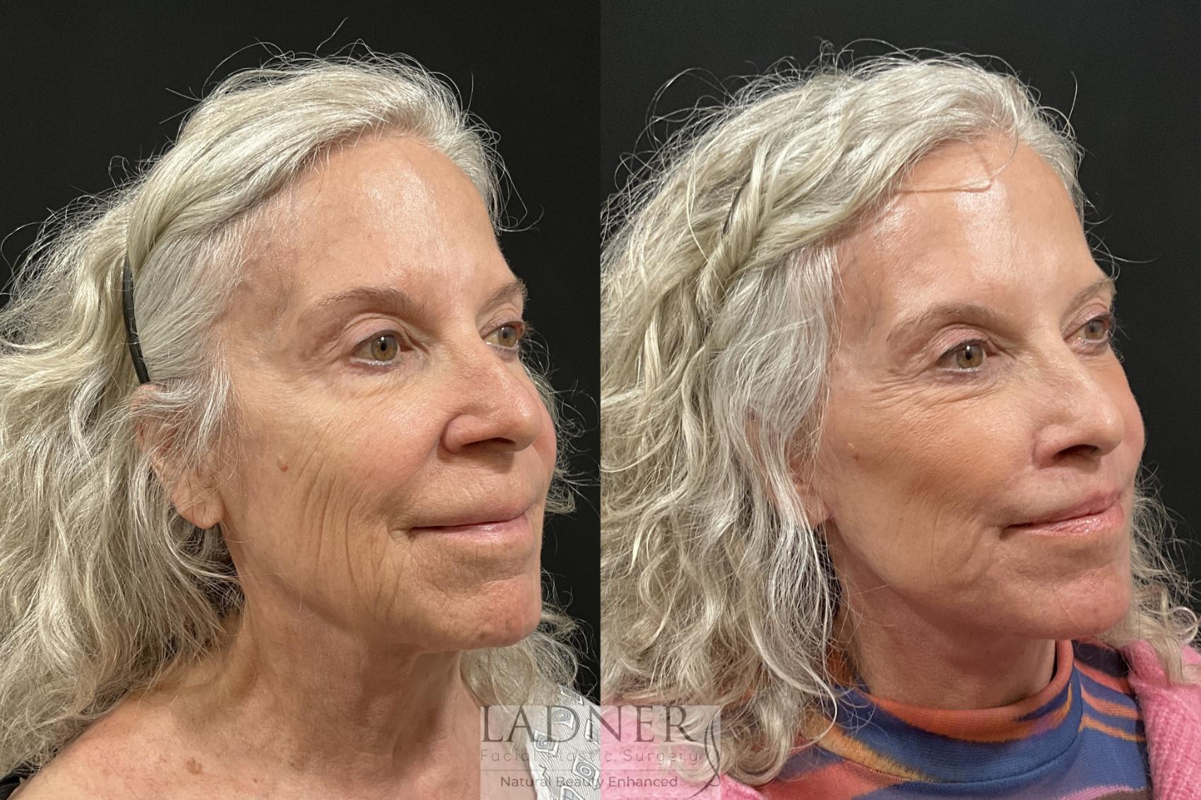 Deep Plane Facelift / Neck Lift Before and After Pictures Case 314 | Denver, CO | Ladner Facial ...