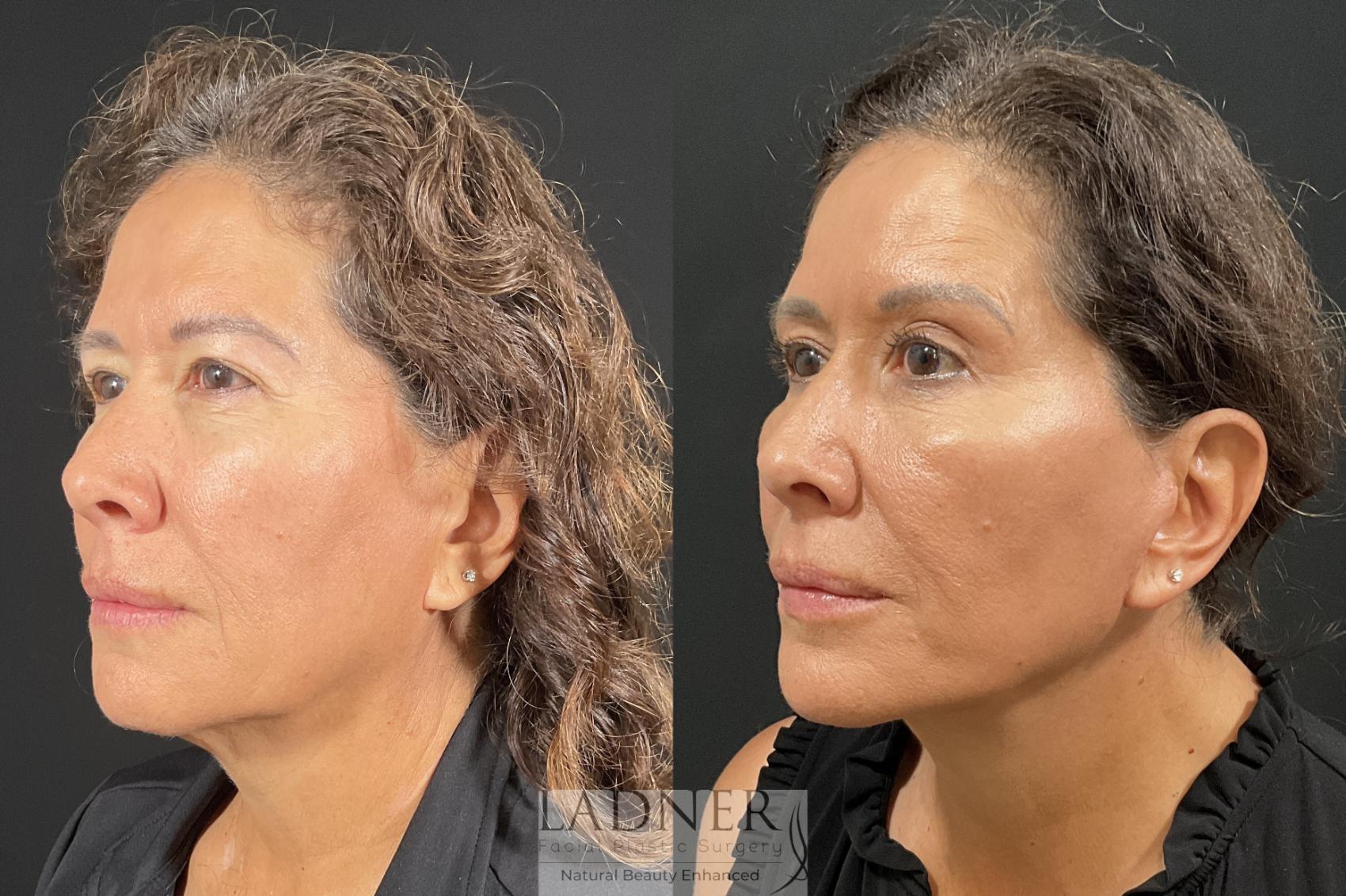 Deep Plane Facelift / Neck Lift Before and After Pictures Case 316 | Denver, CO | Ladner Facial ...