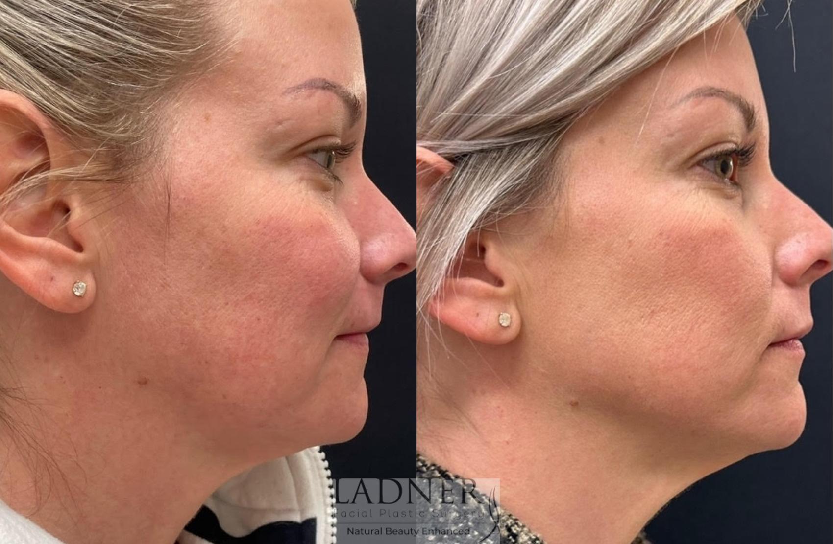 Facial Balancing Before and After Pictures Case 265 | Denver, CO ...