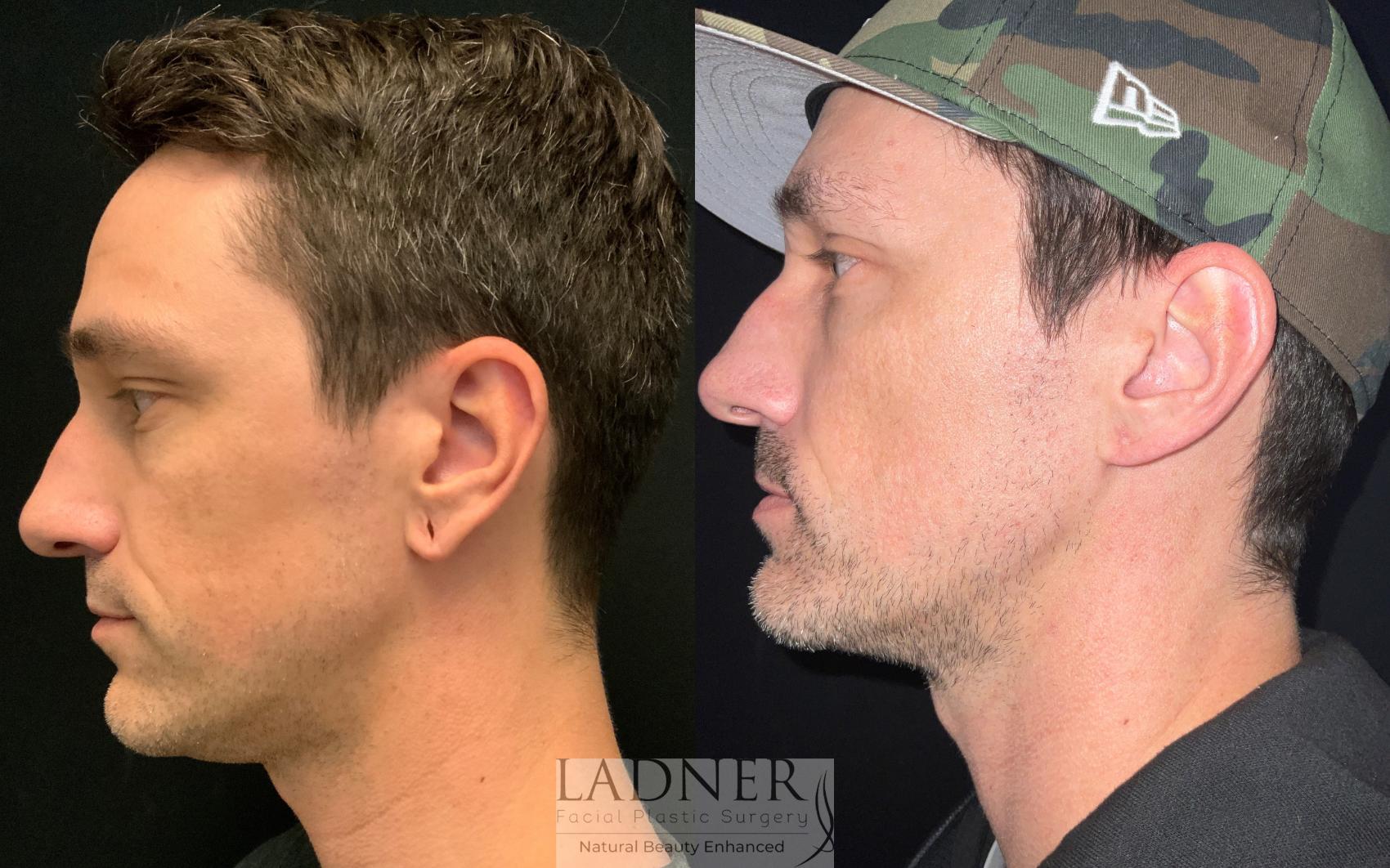 Ear Surgeries Before and After Pictures Case 127 | Denver, CO | Ladner ...