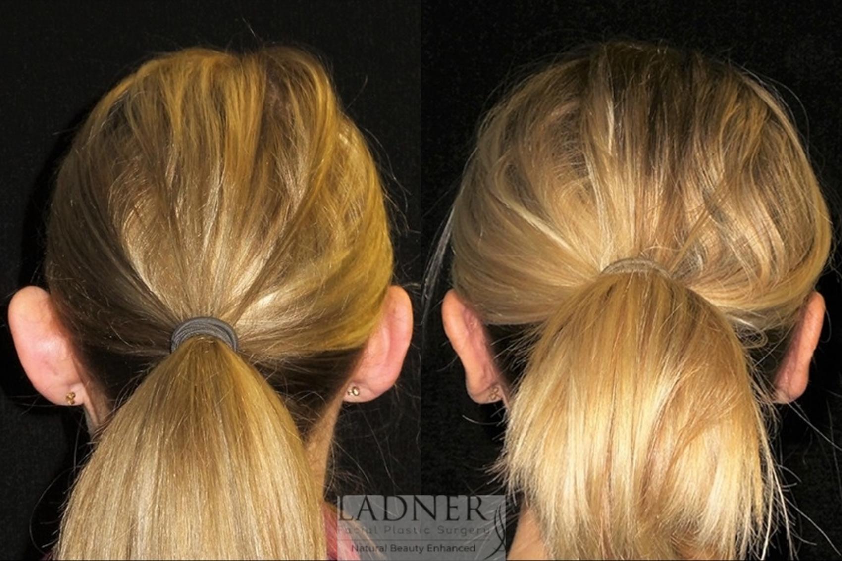 Ear Surgeries Before and After Pictures Case 61 | Denver, CO | Ladner ...