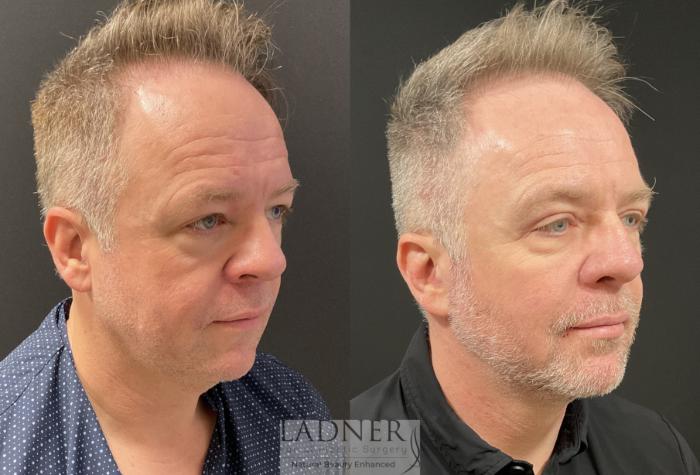 Facial Fat Transfer Before And After Photo Gallery Denver Co Ladner Facial Plastic Surgery