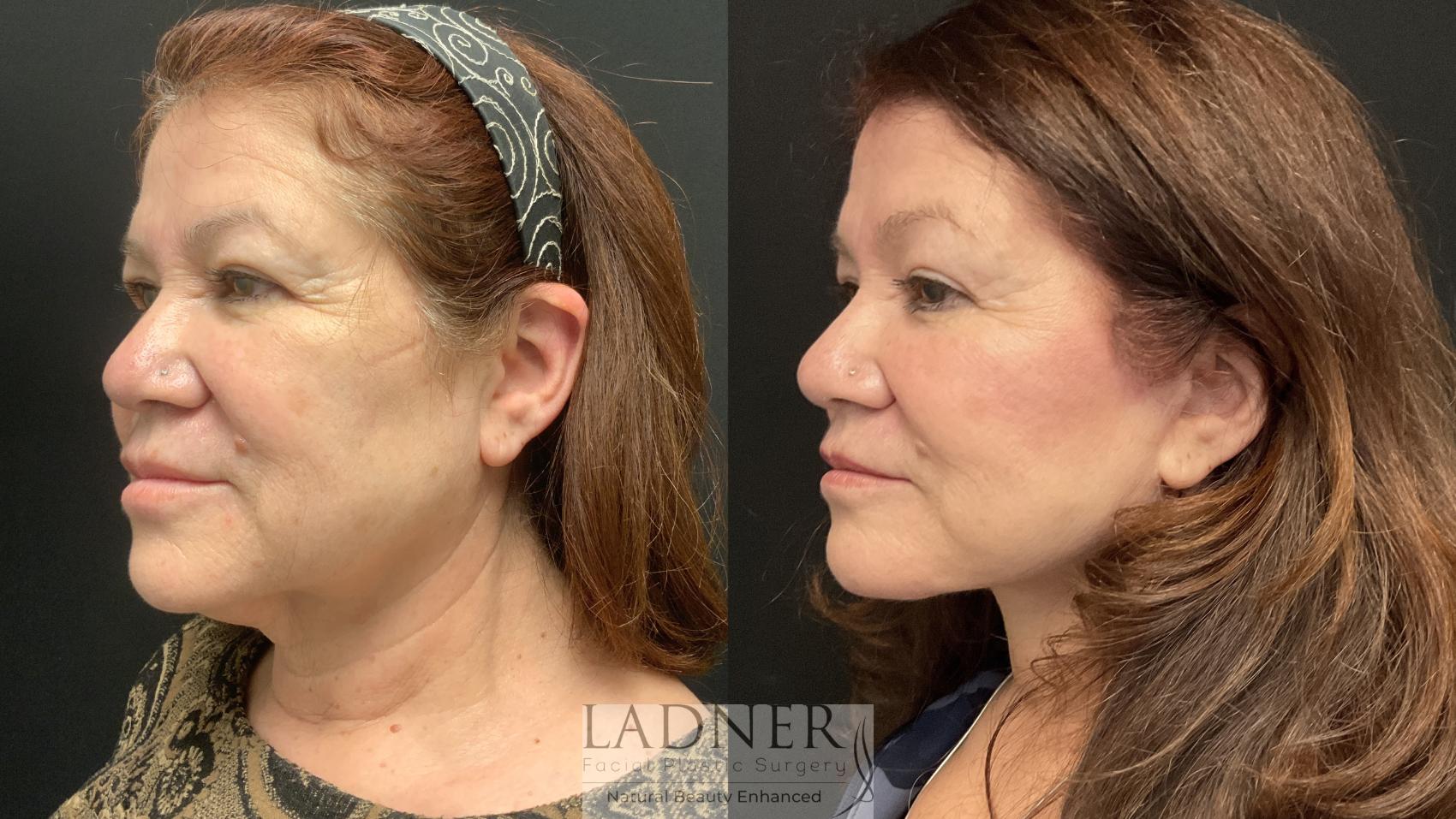 Deep Plane Facelift / Neck Lift Before and After Pictures Case 139 | Denver, CO | Ladner Facial ...