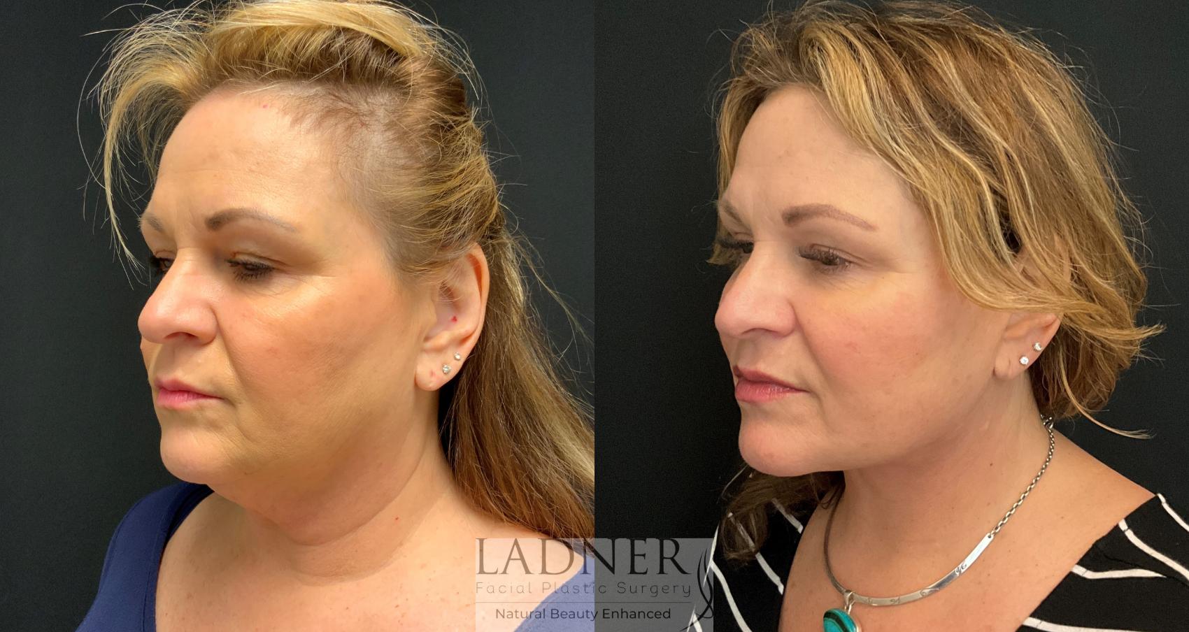 Deep Plane Facelift / Neck Lift Before and After Pictures Case 149 ...