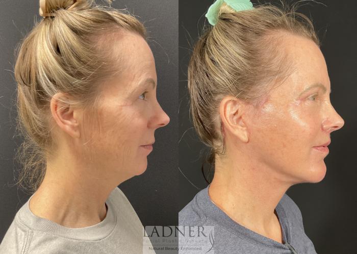 Chin Augmentation Before and After Pictures Case 250 | Denver, CO ...