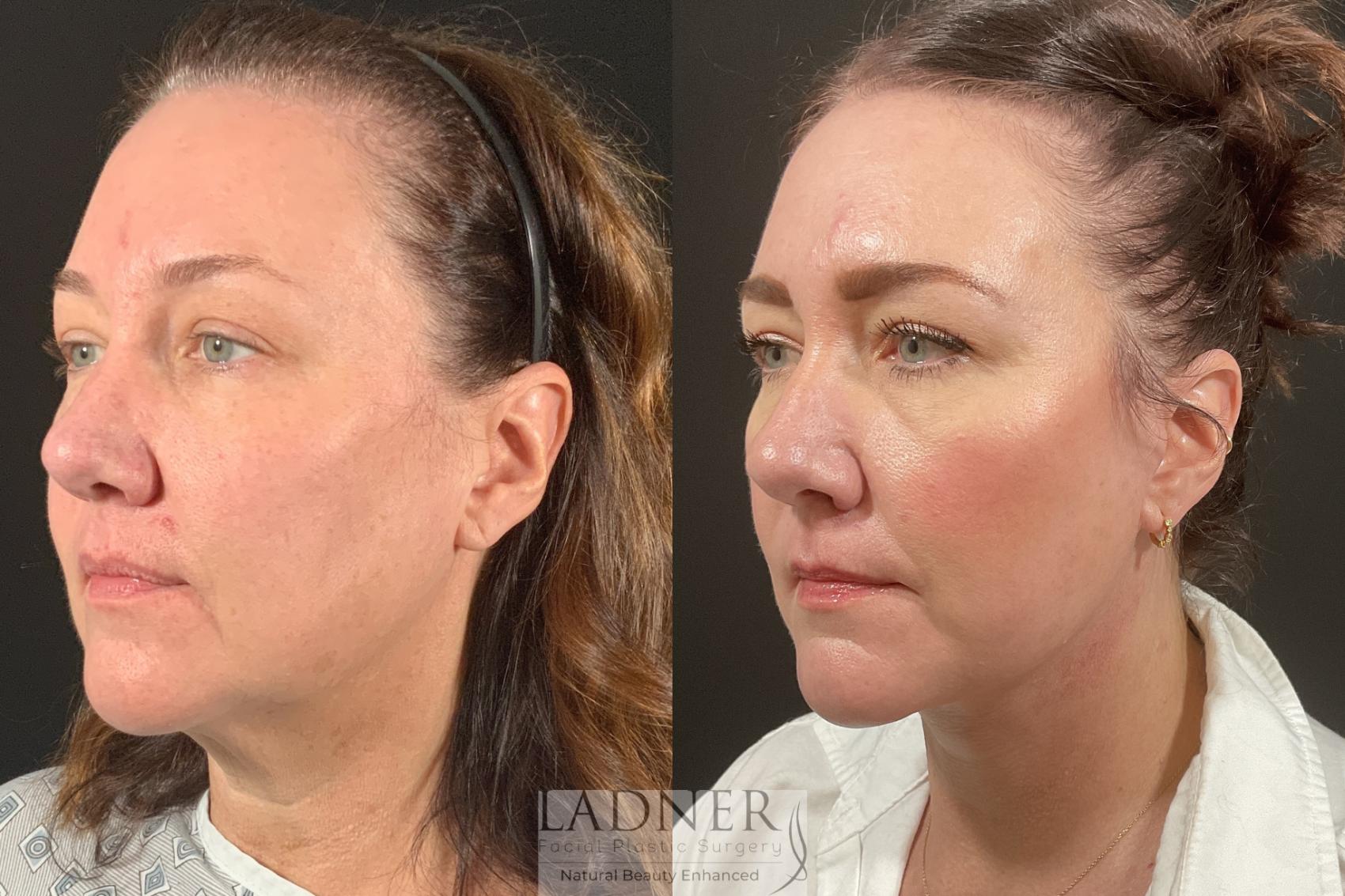 Deep Plane Facelift / Neck Lift Before and After Pictures Case 297 | Denver, CO | Ladner Facial ...
