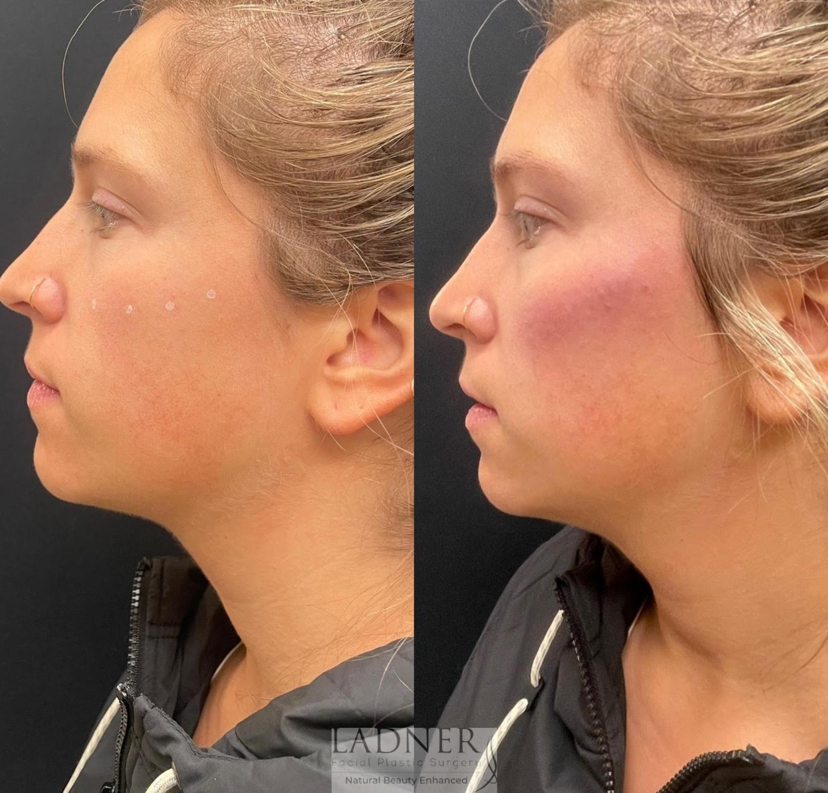 Facial Balancing Before and After Pictures Case 278 | Denver, CO ...