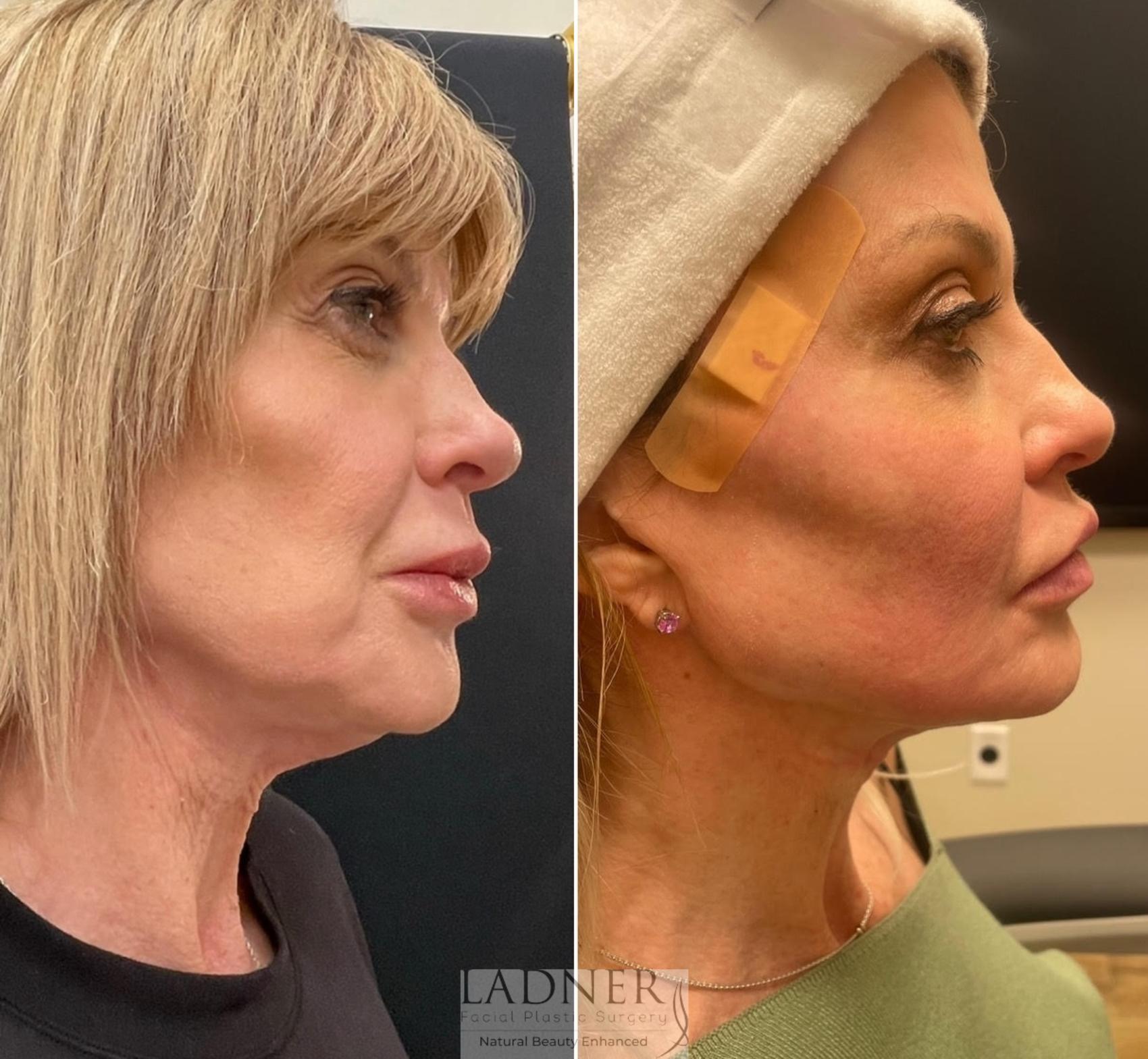 Facial Balancing Before and After Pictures Case 282 | Denver, CO ...