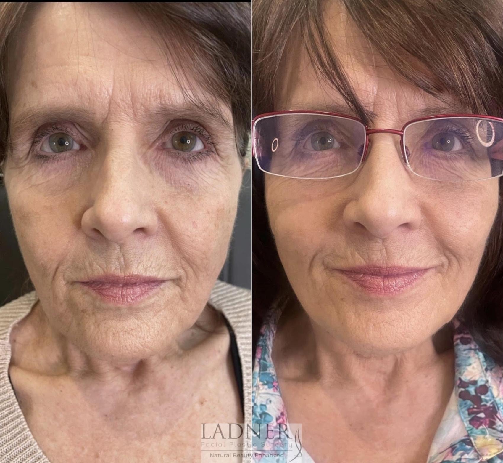 Facial Balancing Before and After Pictures Case 284 | Denver, CO ...