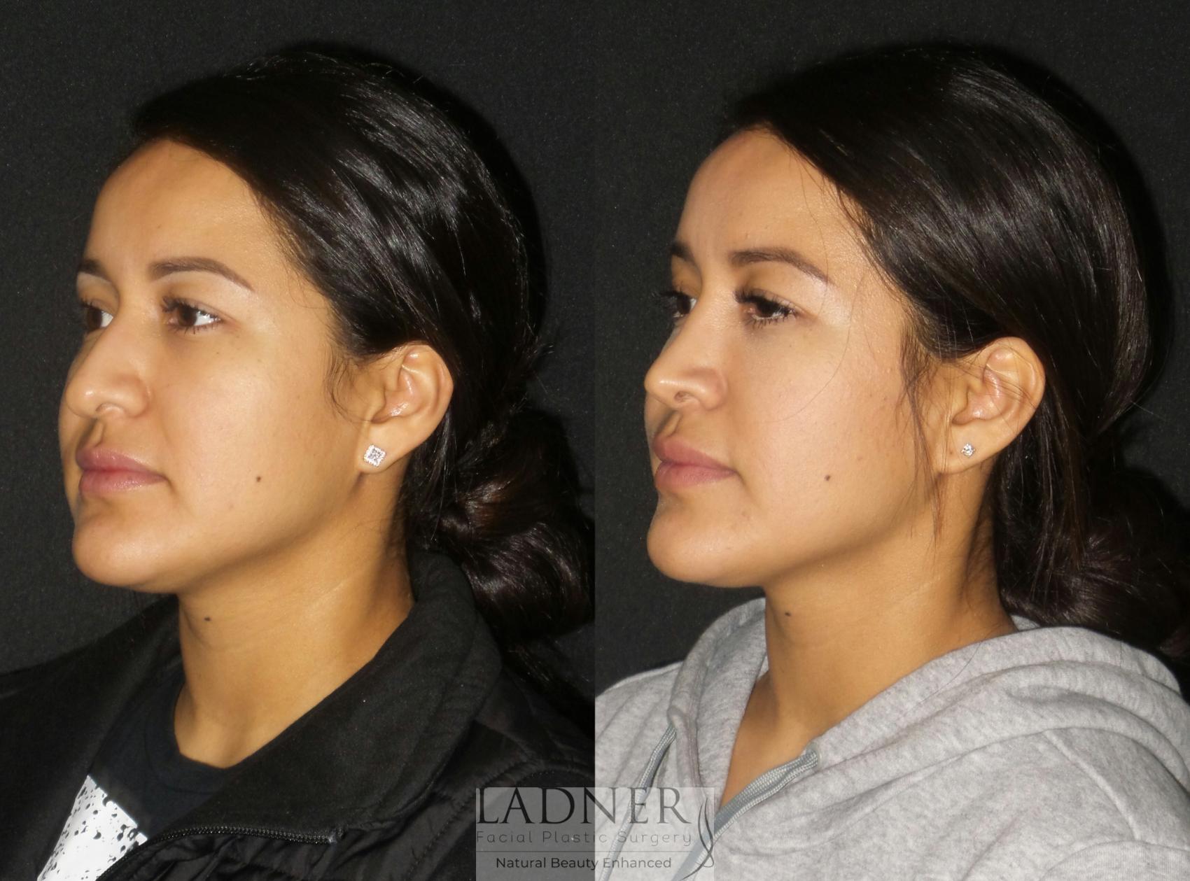 Rhinoplasty (Nose job) Before and After Pictures Case 192 | Denver, CO ...