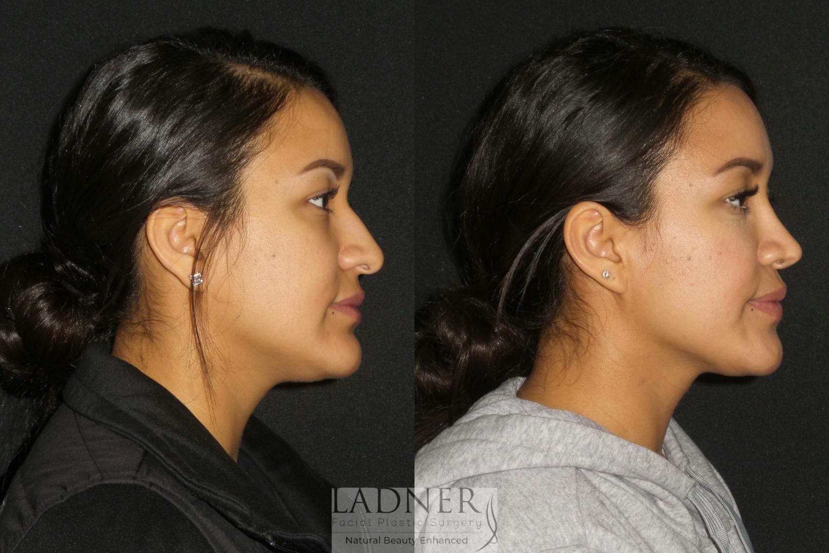 Rhinoplasty (Nose job) Before and After Pictures Case 192 | Denver, CO ...